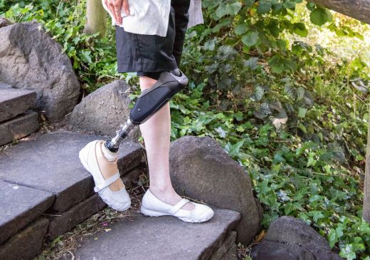 Prosthetic Sockets (Above Knee & Below Knee)